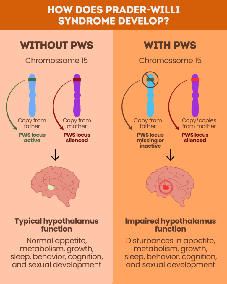 Prader-Willi syndrome: Everything you need to know | Prader-Willi ...